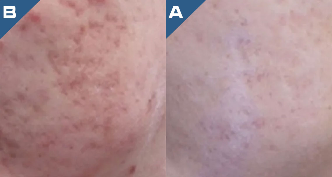 BIOXEL Bioxel Co2 Laser System