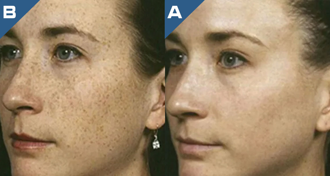 BIOXEL Bioxel Co2 Laser System