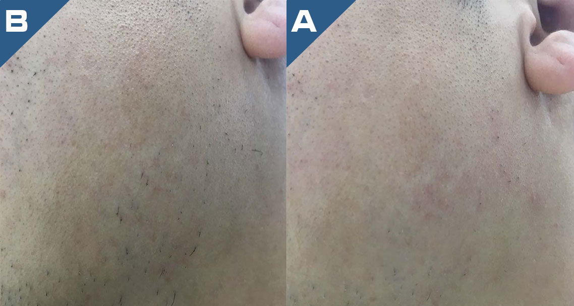 Bison Accento Bison Medical Accento Laser System