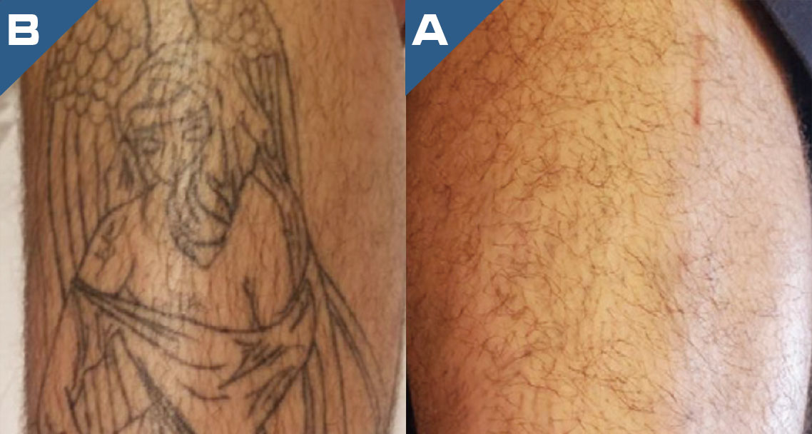 Pico Legend Pico Legend laser system